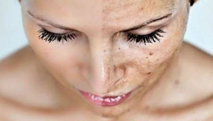 Sol + calor = manchas na pele. Saiba como evitar e tratar! | Blog do ...